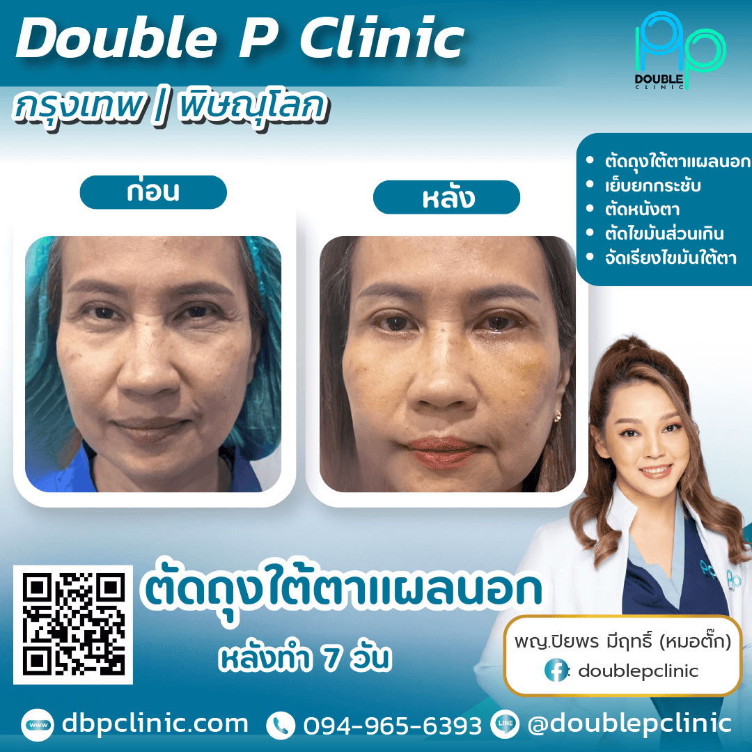 ผ่าตัดถุงใต้ตา อยากหน้าเด็ก ตาใสปิ๊ง ต้องรู้! - Double P Clinic คลินิก ...